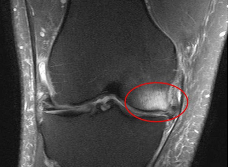 Subchondroplasty / SCP for Bone Marrow Lesions